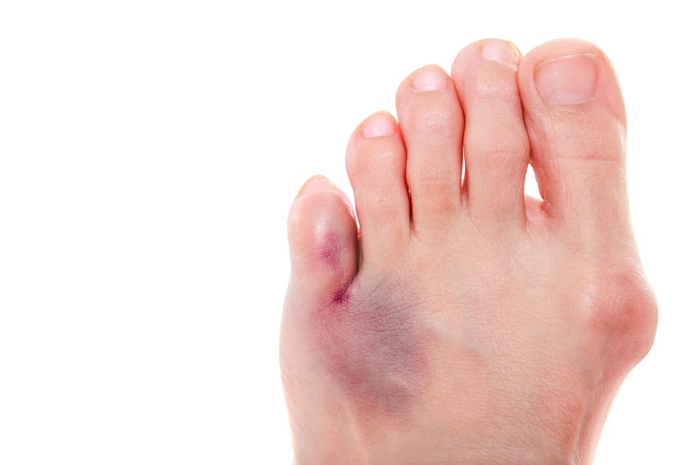 Fractura del quinto metatarsiano: ¿Qué es y cómo tratarla? - La Raza