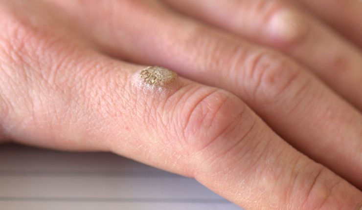 ¿Cuáles son las causas de las verrugas y cómo podemos prevenirlas? | La ...